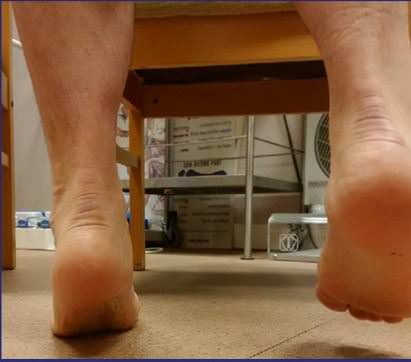 Case study- Orthotic treatment of Plantar Heel Pain | Buchanan Orthotics