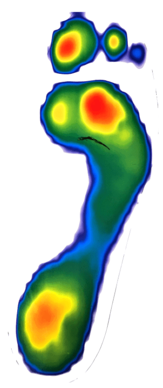 Interdigital Neuromas & Morton's Neuroma: A Clinical Guide |Buchanan ...