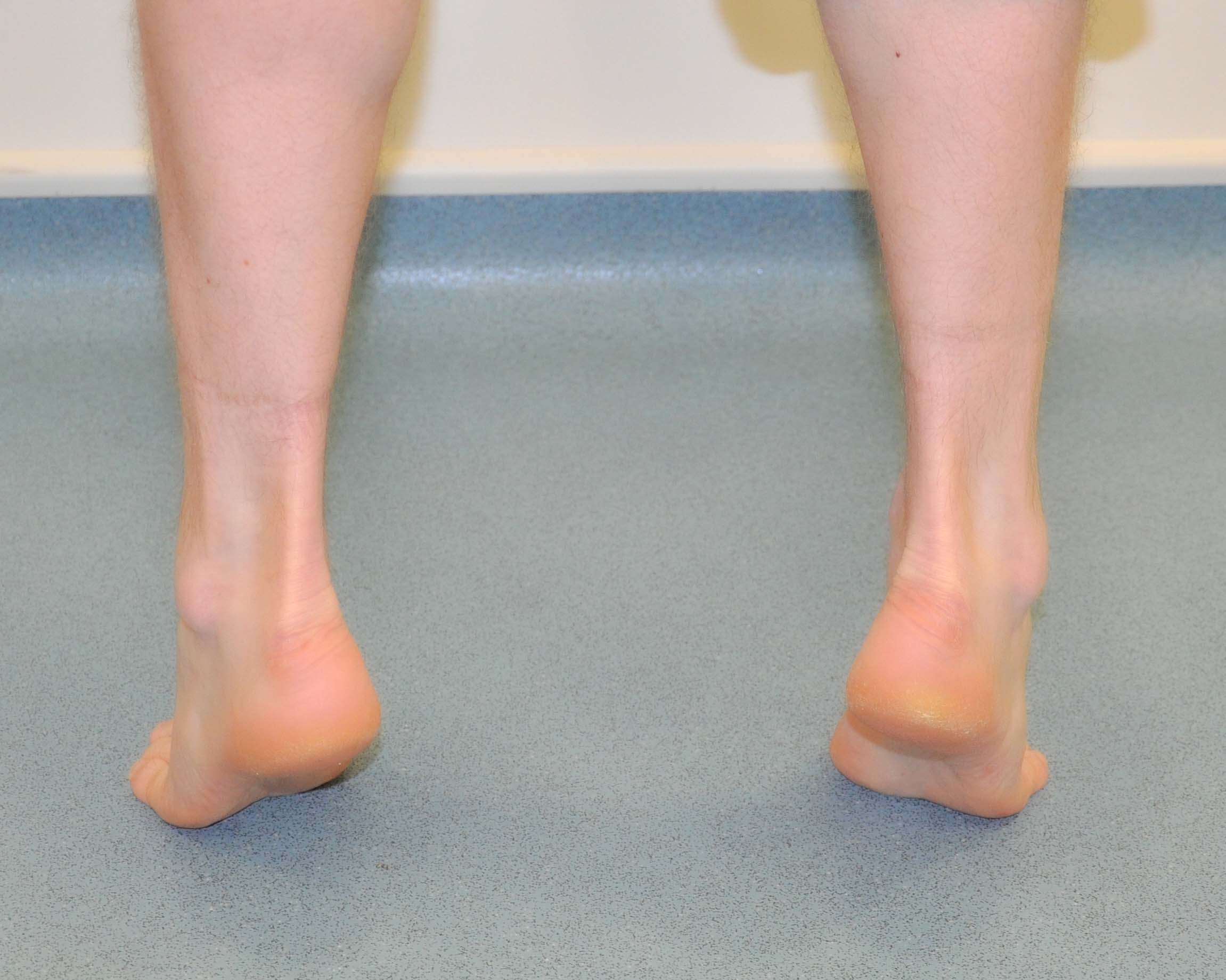 Adult Flat Foot and PTTD Insole guide |Buchanan Orthotics